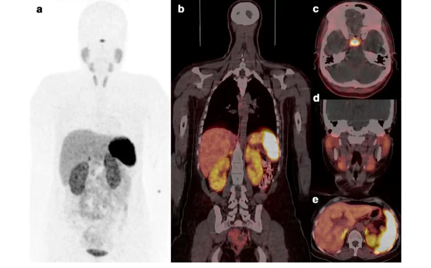 PET CT Com Dotatoc | CDI PREMIUM
